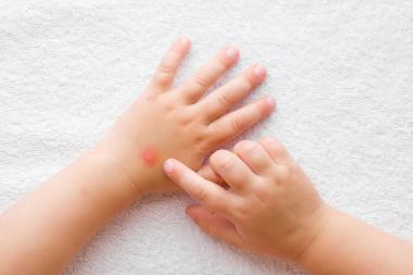 Insectenbeten bij kinderen | WIJ.nl